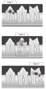 Feline Oral Resorptive Lesions in Cats – My Vet Animal Hospital